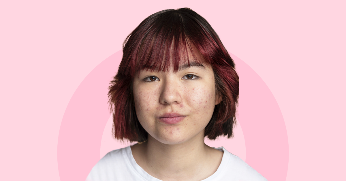 Cystic Acne: Causes And Treatment | Ova SG