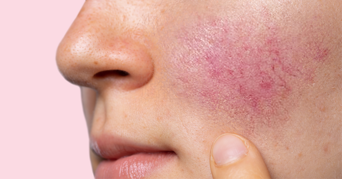 Rosacea Skin: 8 FAQs Answered To Treat Rosacea Prone Skin | Ova SG