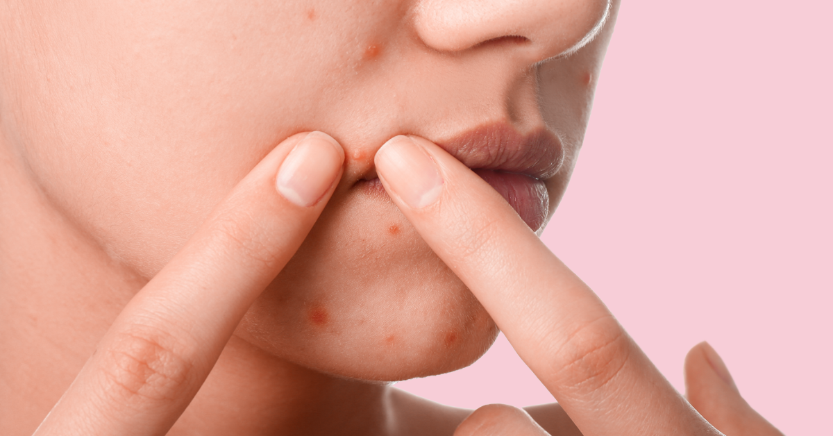 Acne Vulgaris: Types, Symptoms, And Treatment | Ova SG